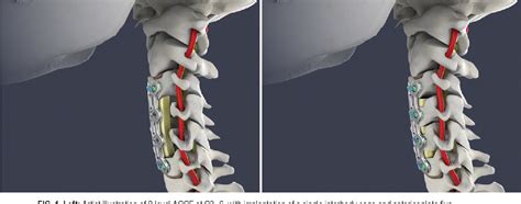 Figure 1 From Two Level Corpectomy Versus Three Level Discectomy For Cervical Spondylotic