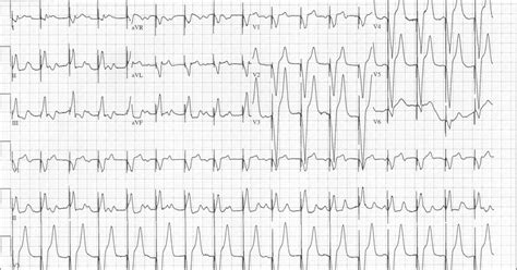 Post Implantation Of A Single Lead Vvi Transvenous Pacemaker