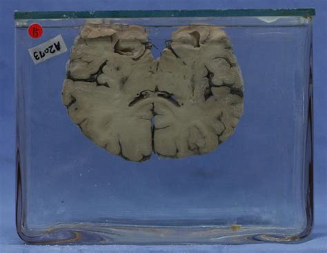 神经疾病 59 15 双侧丘脑腔隙性出血伴梗死 病理标本博物馆 复旦大学基础医学院