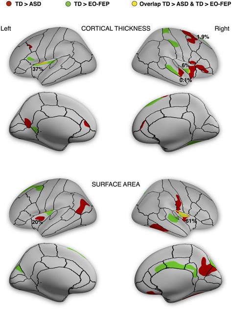 Cortical Thickness And Surface Area Reductions In Asd And Eo‐fep