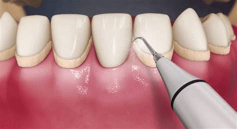 Ultrasonic Scaling Dental Clinic In Dhaka Bangladesh Prof Dr Nasir Uddin Ultrasonic Scaling Dental Clinic In Dhaka Bangladesh Prof Dr Nasir Uddin