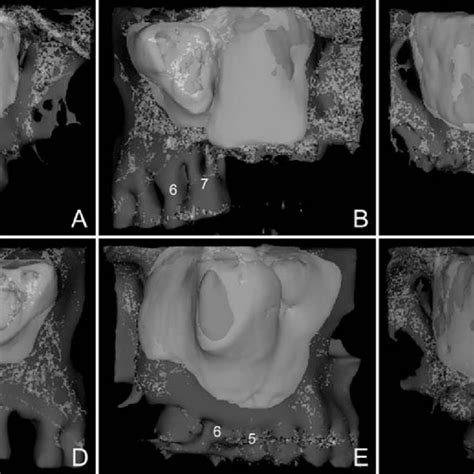 Pdf Personal Computer Based Three Dimensional Reconstruction And Simulation Of Maxillary Sinus
