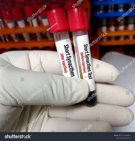 Bloods Sample Short Synacthen Test Before Stock Photo 2211846691 Shutterstock