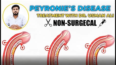 Peyronies Disease Treatment Without Surgery Dr Usman Ali Non