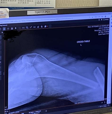 Complete Femur Fracture Before And After Orif R Radiology