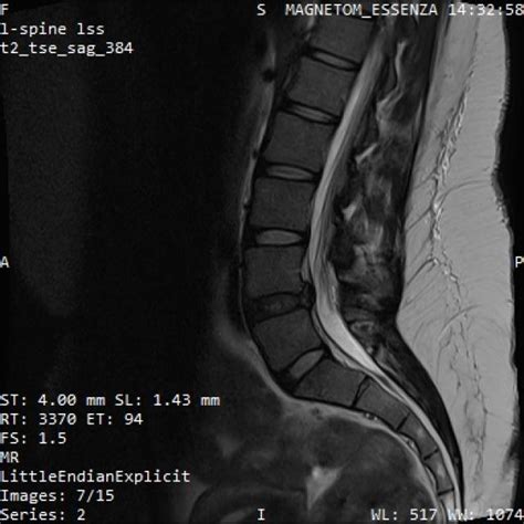 Lumbar Spine Diagnosis Object Detection Model By Video Text Summarization