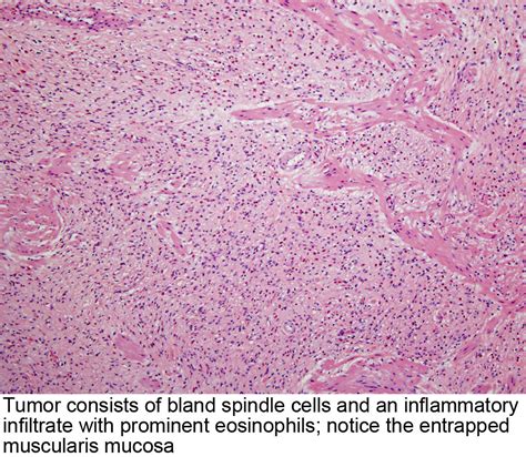 Pathology Outlines Inflammatory Fibroid Polyp