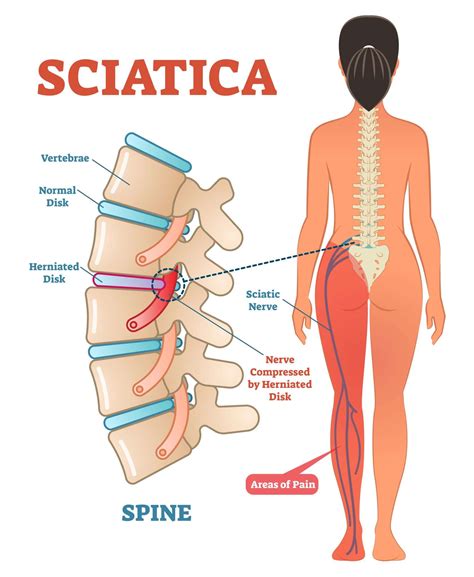 Sciatica Symptoms Causes And Treatments Sussex Back Pain Clinic