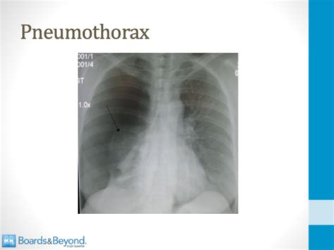 Atelectasis Vs Pneumothorax