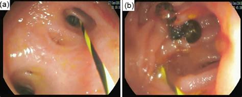 Hepaticojejunostomy With Gastric Access Loop Versus Conventional Hepaticojejunostomy A