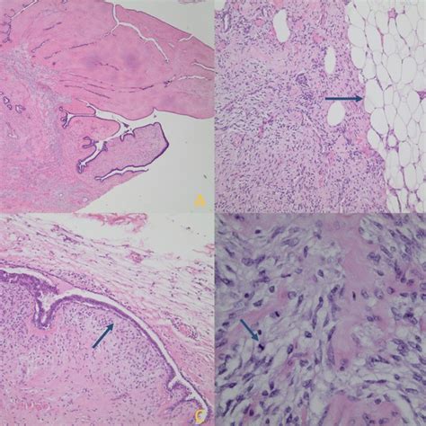 Histological Findings Of Lumpectomy Of The Borderline Phyllodes Tumor