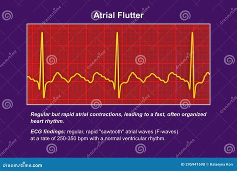 Ecg In Atrial Flutter An Abnormal Heart Rhythm Characterized By Rapid Regular Contractions Of