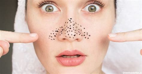 عکس دختر با صورت پر جوش