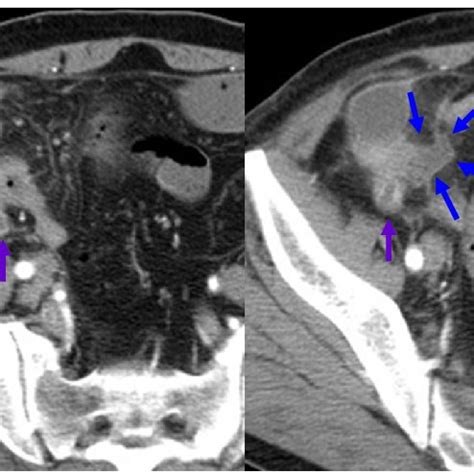 CT Findings Of Acute Appendicitis A Swollen Appendix Purple Arrows Download Scientific