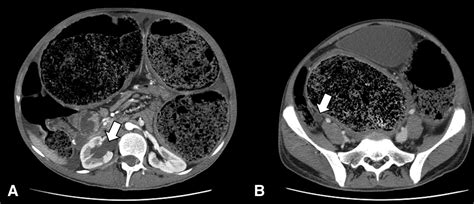 Threatening Fecal Impaction Journal Of Emergency Medicine