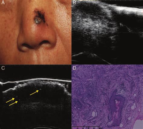 Basosquamous Cell Carcinoma Clinical A Ultrasonographic B C And