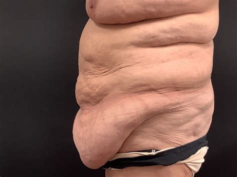 Tummy Tuck With Liposuction