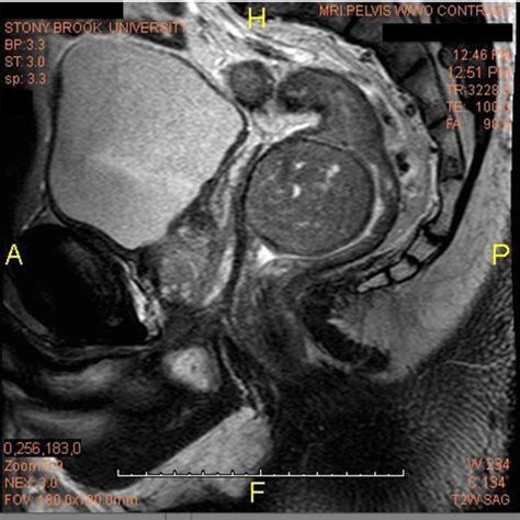 Surgical Pathology A Rectal Gist With Adjacent Rectal Mucosa 20×