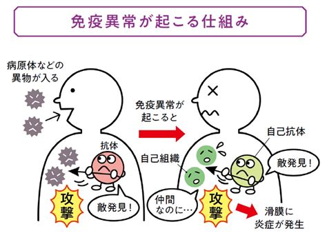 関節リウマチ｜原因・症状・対処法｜大正健康ナビ｜大正製薬