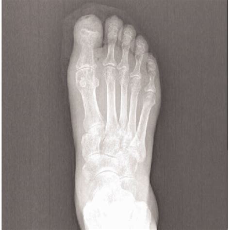 Right Hallux Amputation With Necrotic Tissue Debridement And