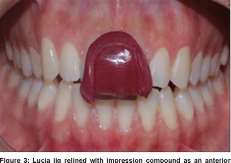 Figure 3 From Comparison Of Sagittal Condylar Guidance Angle Obtained
