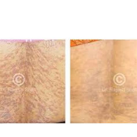 Lichen Planus Treatment At Best Price In Noida ID