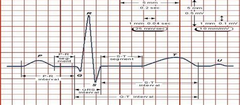 Figure 1 From Algorithm For The Representation Of Parameter Values Of Electrocardiogram