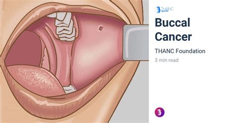 Buccal Cancer ‣ Anatomy ‣ Thanc Guide 51 Off