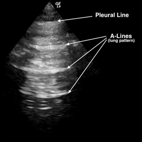 Demonstration Of Pocus Thoracic “quick Look” Exam Download Scientific
