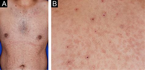 Secondary Syphilis Occurring Under Anti Cd20 Therapy Risks
