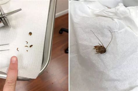 Cockroach Crawls Into Womans Ear Takes Nine Days To Remove