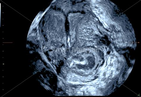 Cervical Ectopic Pregnancy Ius In Situ — Dr Simon Events And Webinars