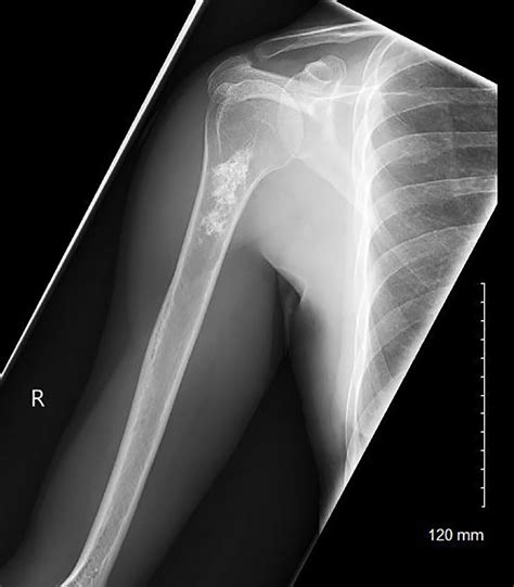 Enchondroma Humerus