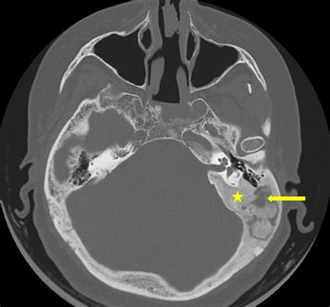 Pagets Disease Of Temporal Bone At Elijah Topp Blog