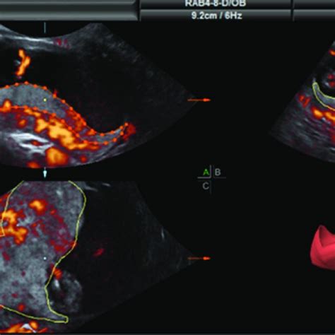 Vocal Virtual Organ Computer Aided Analysis Analysis Of Vascular
