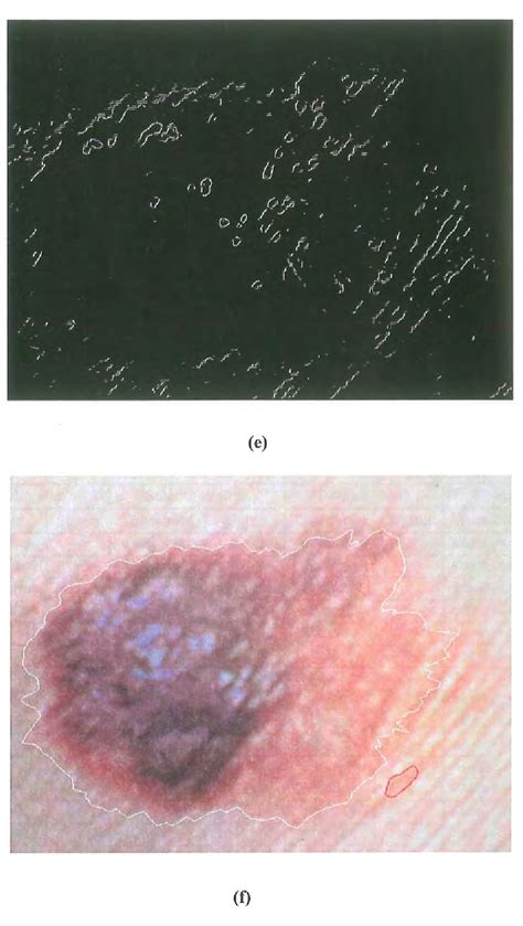 Figure From A Comparison Of Edge Detection Methods For Segmentation Of Skin Lesions In Mobile