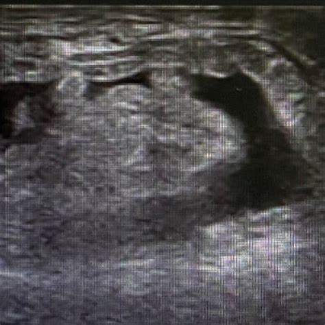 Appendix And Femoral Ring The Arrow Shows The Appendix The Appendix Download Scientific