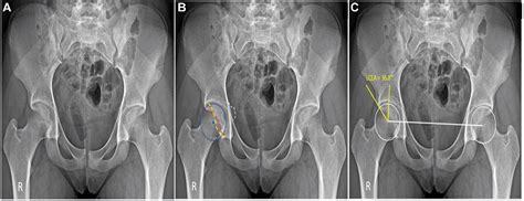 Figure 1 From Hips With Acetabular Retroversion Can Be Safely Treated With Advanced Arthroscopic