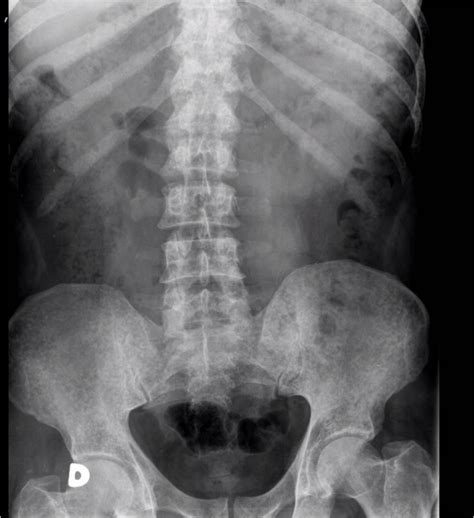 Differential Diagnosis Of Diffuse Bony Sclerosis Pacs