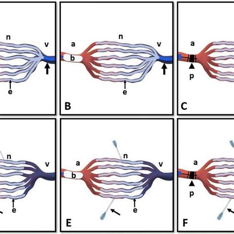 A Avm Of The Glabellar Region Discoloration Swelling And Pulsations Download Scientific