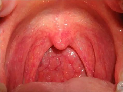 Atrophic Pharyngitis Causes And Treatment Health