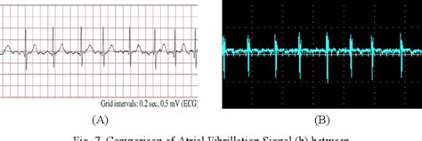 Figure 7 From Development Of Electrocardiogram Signal Generator For Fibrillation Detector