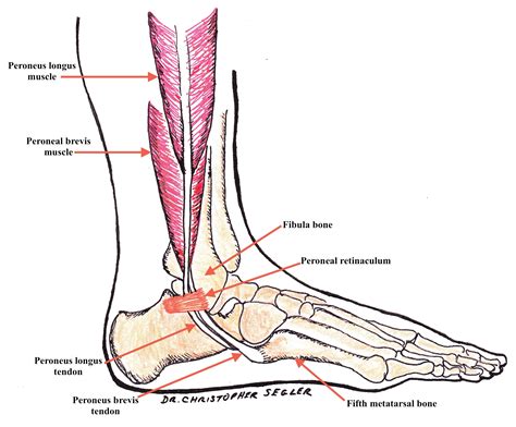 Peroneal Tendon Subluxation Surgery