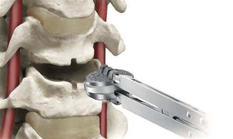 Cervical Disc Replacement Spine Surgery Institute