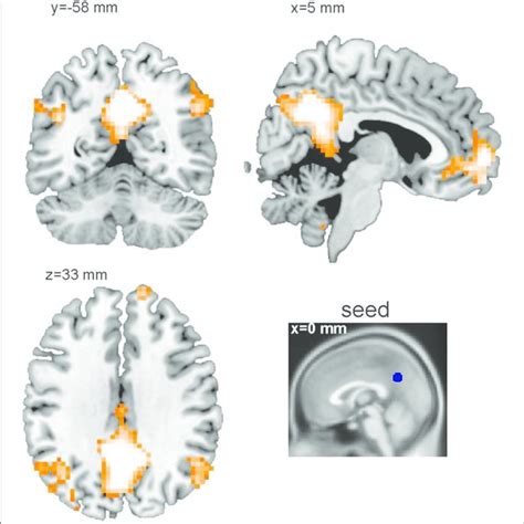Seed Based Functional Connectivity Analysis Single Subject Level