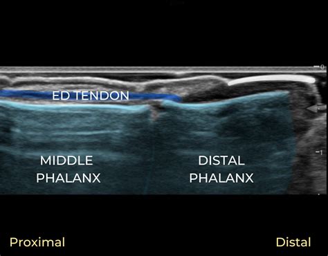 Hand Msk Ultrasound Rita Chorba Dpt