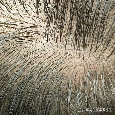 越拖越秃,脱发不仅要及时治疗,还要使用正确方法 知乎 越拖越秃,脱发不仅要及时治疗,还要使用正确方法 知乎