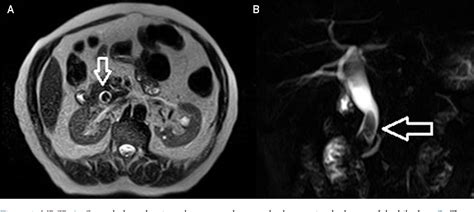 Figure 1 From Treatment Of Choledocholithiasis By Ercp And