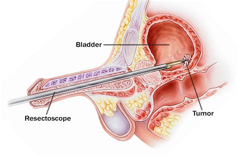 Transurethral Resection Of Bladder Tumor Turbt