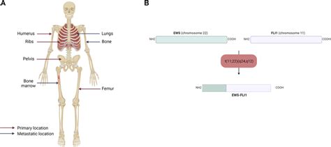 A Primary And Metastatic Sites Of Ewing Sarcoma Ewing Sarcoma Mainly Download Scientific
